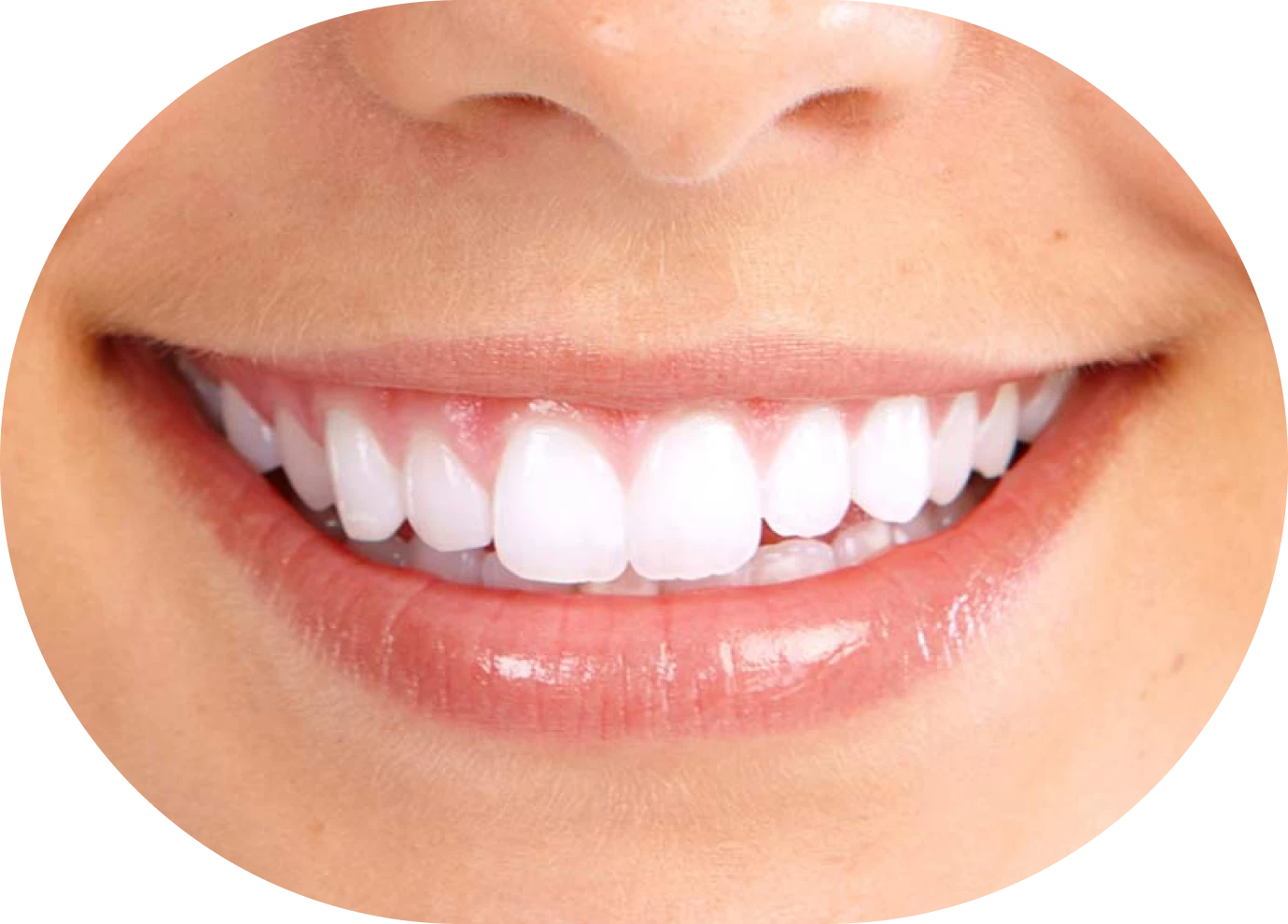 Carie | Dr Guillaume Fuchs | Dentiste | Bain-de-Bretagne